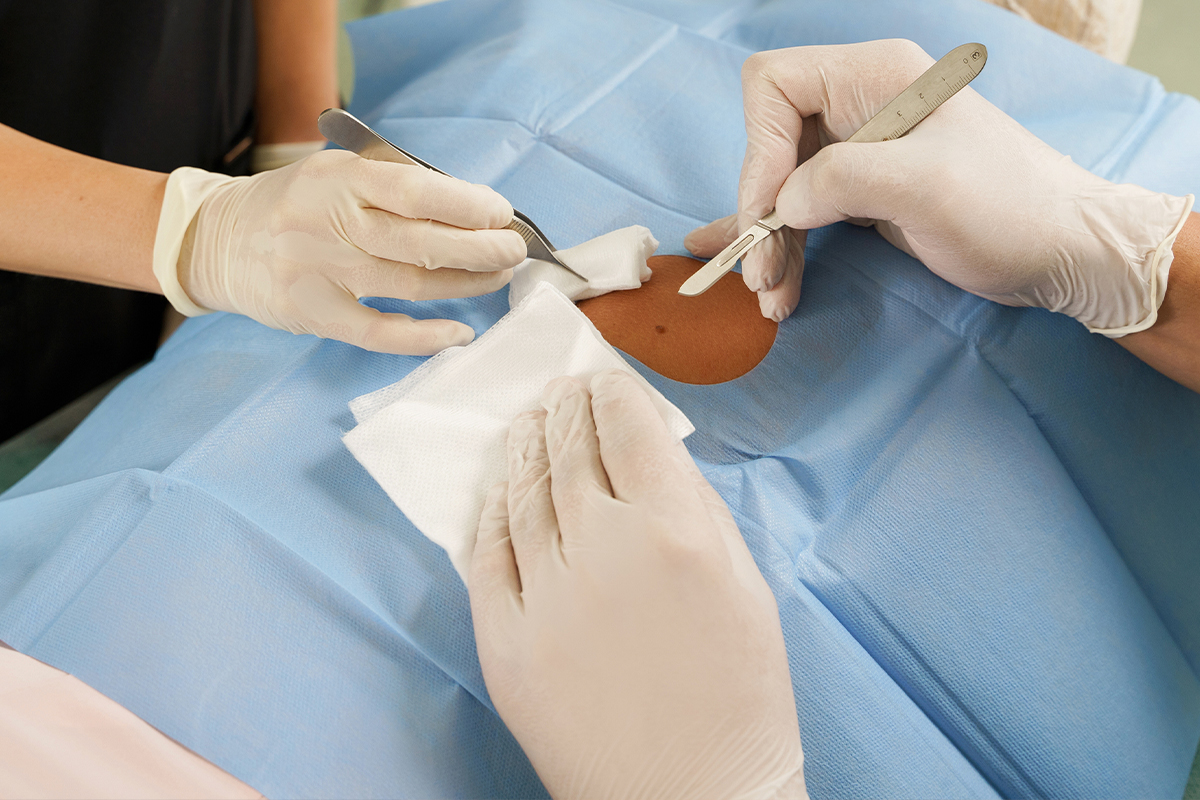 Skin Cancer Surgery in Bridgewater, NJ | Skin Cancer Removal