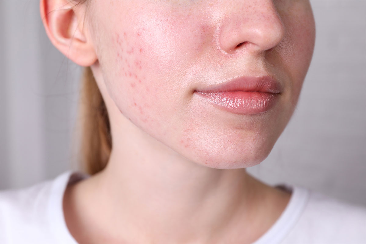 Rosacea Treatment in Bridgewater, NJ | Curated Dermatology