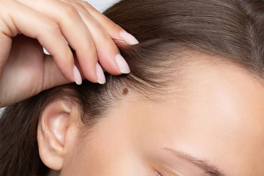 Skin Tags & Moles in Bridgewater, NJ | Curated Dermatology
