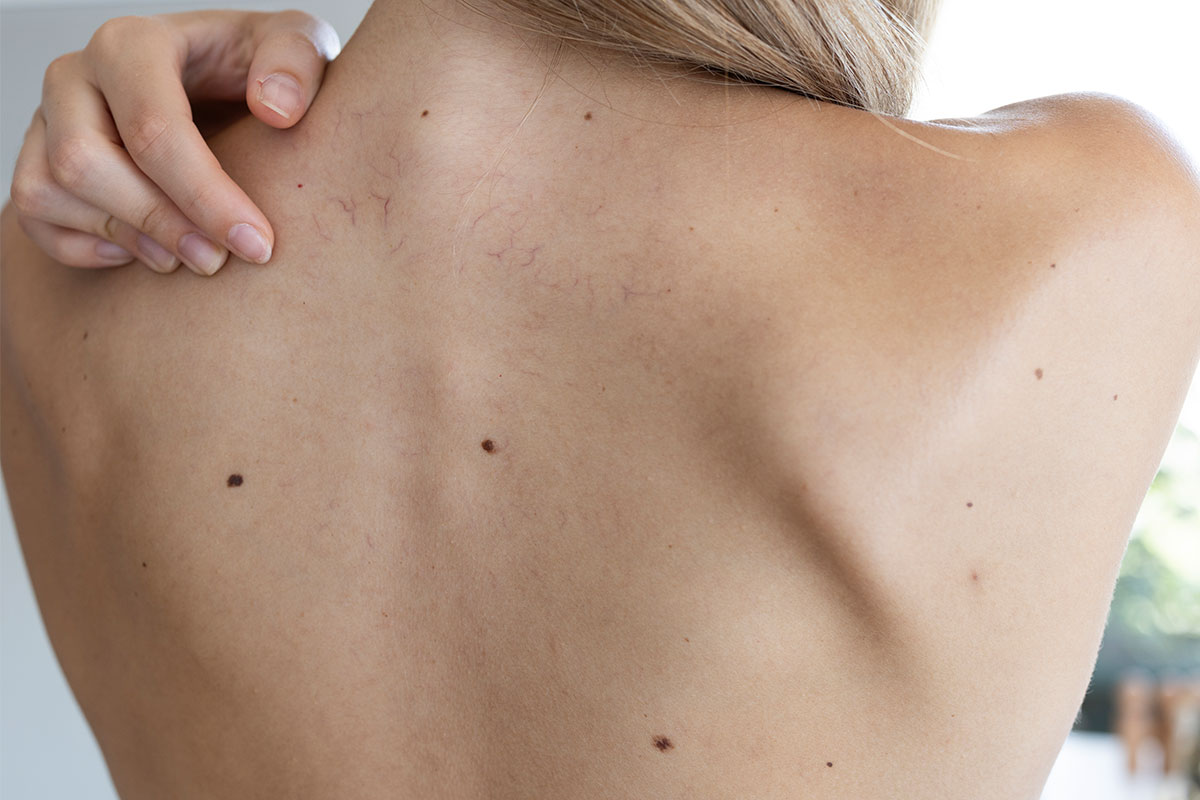Skin Tags & Moles in Bridgewater, NJ | Curated Dermatology